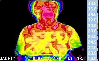 #2 Teletherm infrared images of the breast - Thermal Image Library