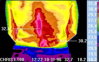 #1 Teletherm infrared images of the back - Thermal image library